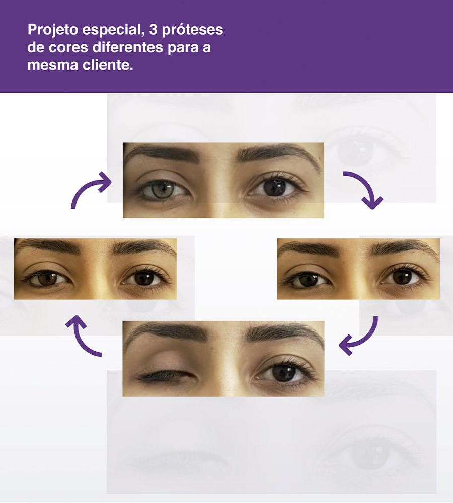 Prótese Ocular Sob Medida Preço - RETOEDU